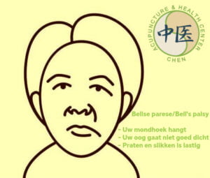 Aangezichtsverlamming van Bell - Acupunctuur en Gezondheidscentrum Chen